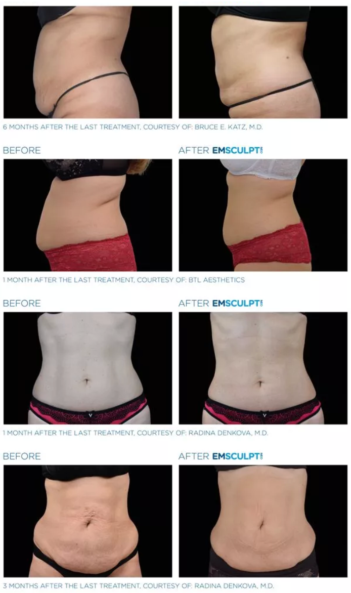 Découvrez Physiosculpt chez Maison Epigenetic – Non Invasif et Efficace